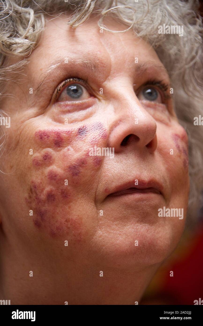Laser treatment for age spots. 71-year-old woman with laser burn marks ...