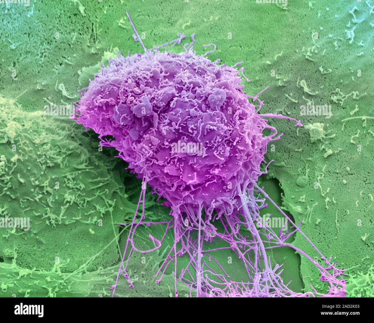 Cervical cancer cell. Coloured scanning electron micrograph (SEM) of a ...