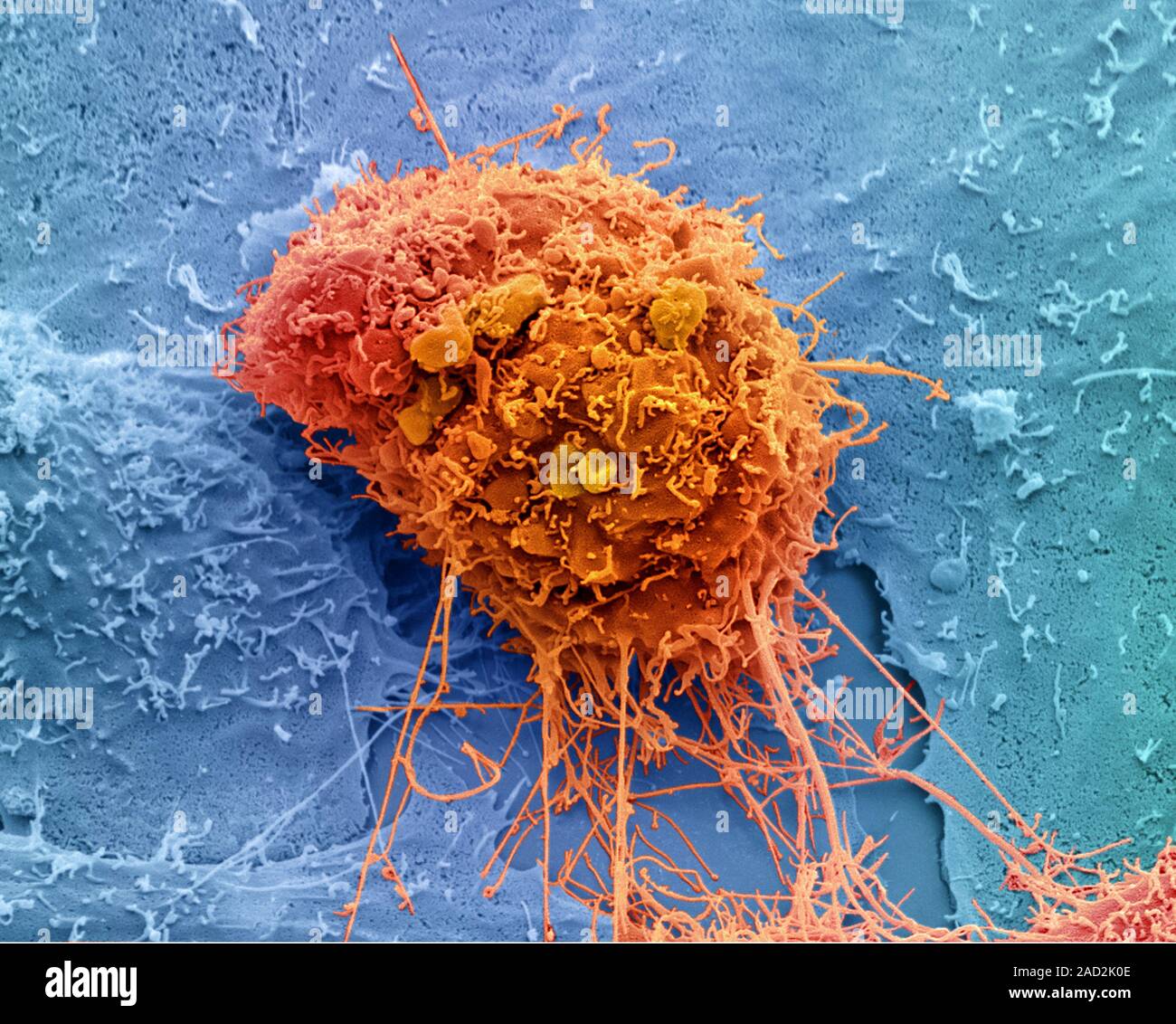 Cervical cancer cell. Coloured scanning electron micrograph (SEM) of a ...