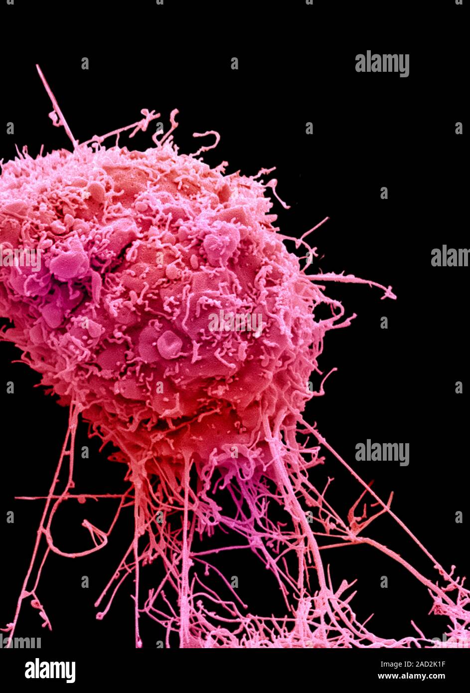 Cervical cancer cell. Coloured scanning electron micrograph (SEM) of a ...