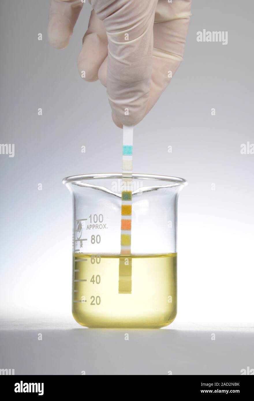 Home urine test. Home test kit for testing urine for signs of diabetes ...