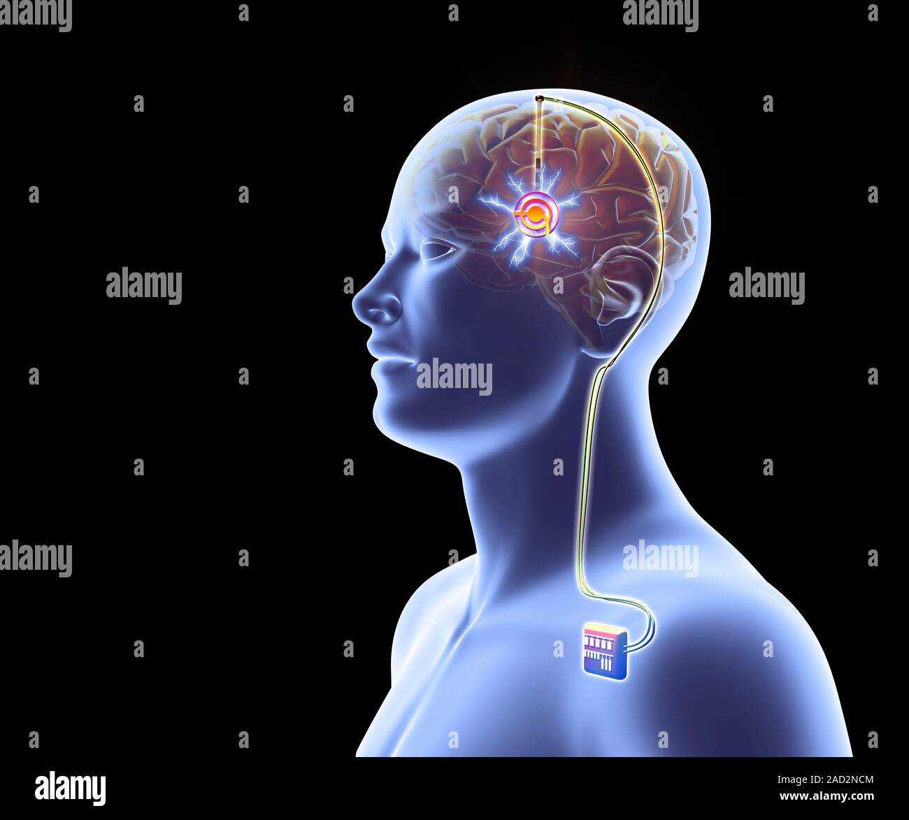 Deep brain stimulation, computer artwork. This neurosurgical treatment ...