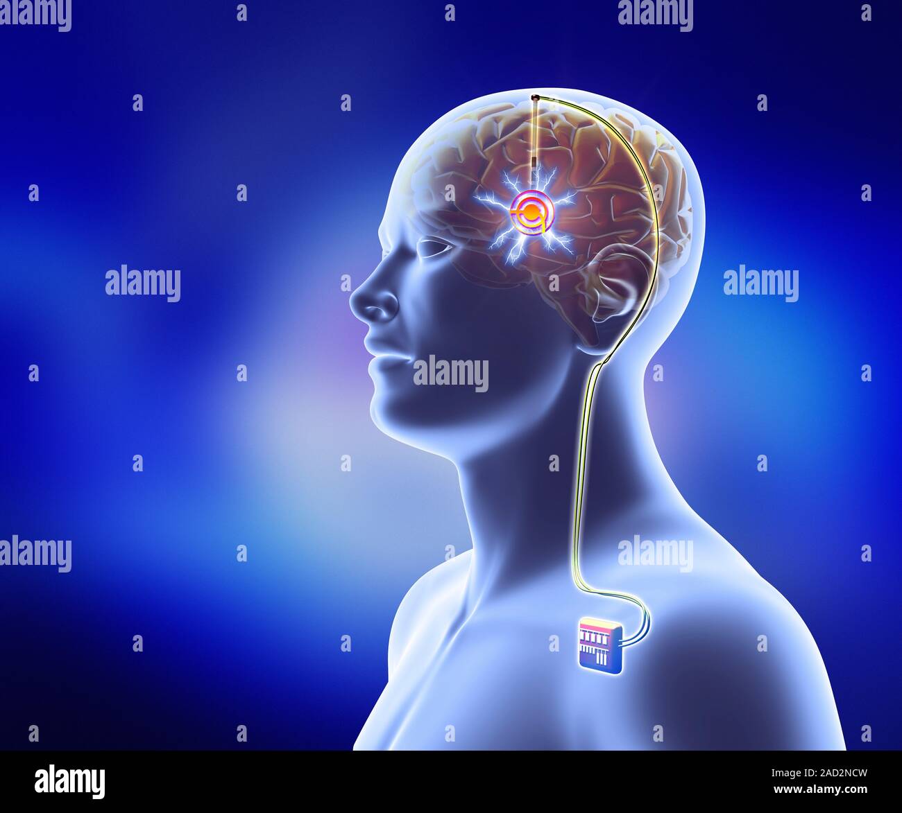 Deep brain stimulation, computer artwork. This neurosurgical treatment ...