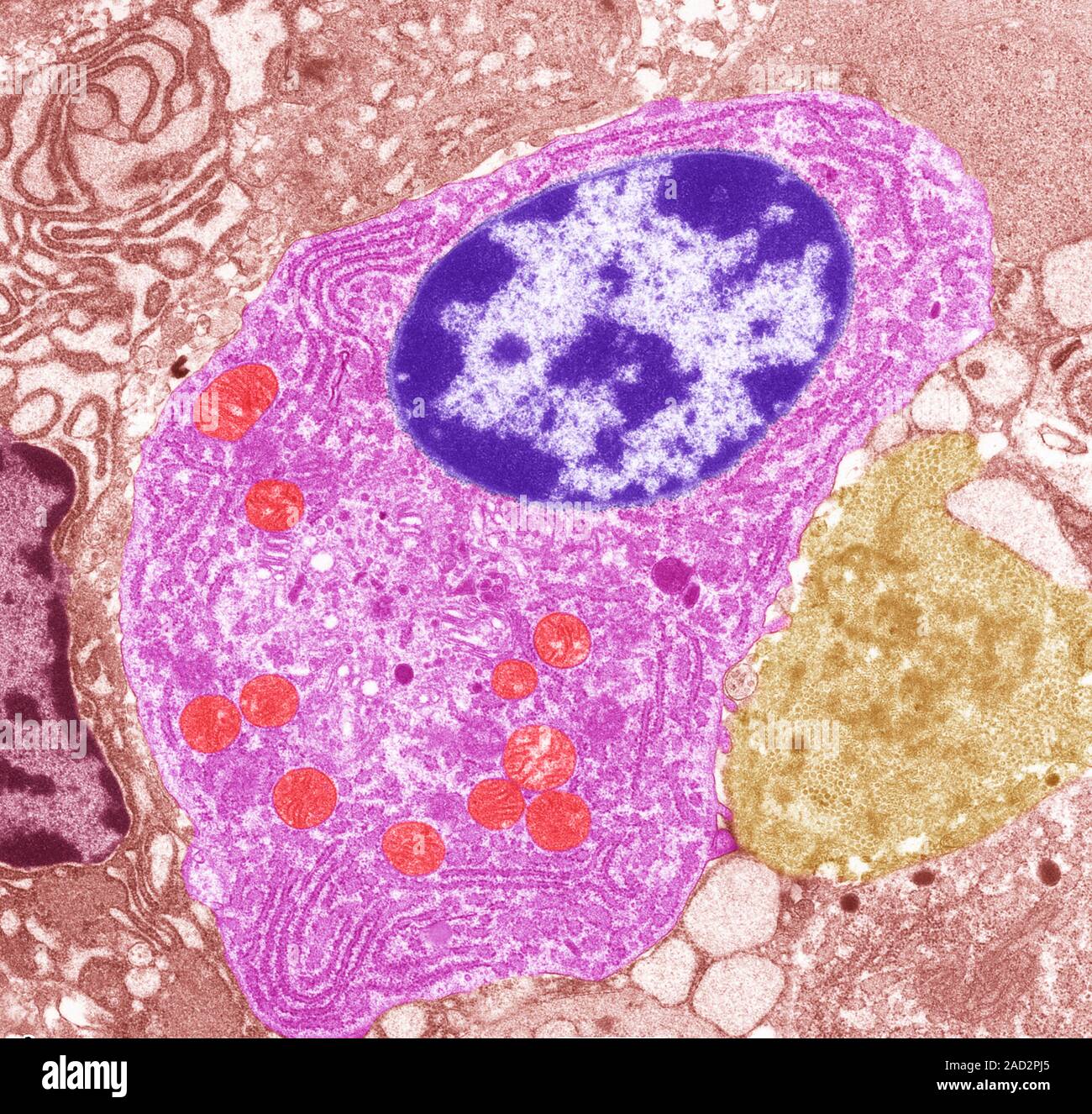 Thyroid cancer cell. Coloured transmission electron micrograph (TEM) of ...