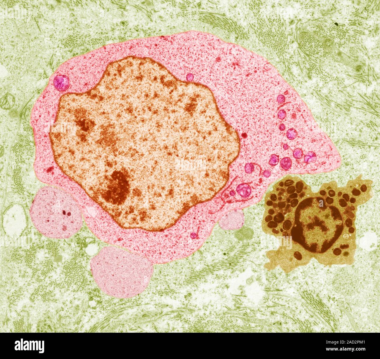 Testicular cancer. Coloured transmission electron micrograph (TEM) of a ...