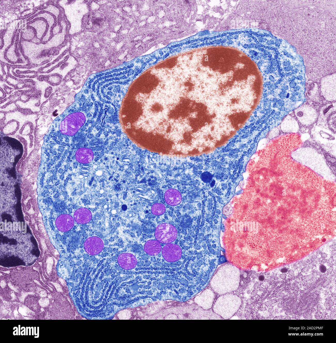 Thyroid cancer cell. Coloured transmission electron micrograph (TEM) of ...