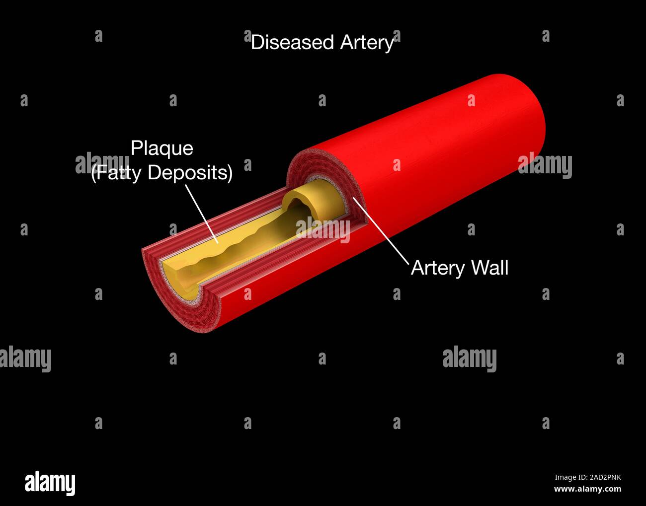 Atherosclerosis. Cutaway computer artwork showing the interior of an ...