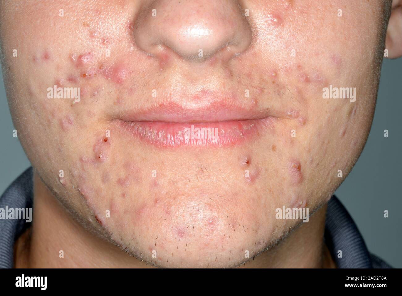 Acne. Close-up of the face of a 20-year-old male patient with acne ...