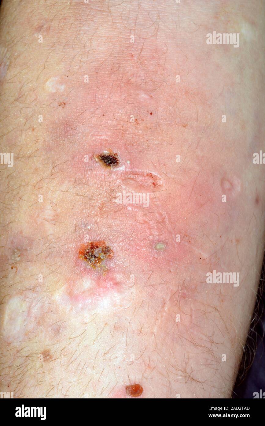 Cigarette burn scars in self-harm. Close-up of infected scars from ...
