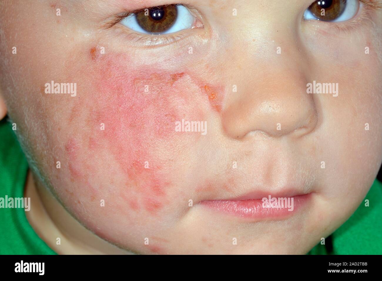 Cellulitis of the face. Close-up of cellulitis affecting the cheek of a ...