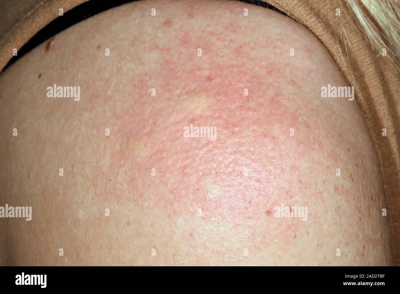 Allergic reaction to spider bite. Close-up of the swollen shoulder of a ...