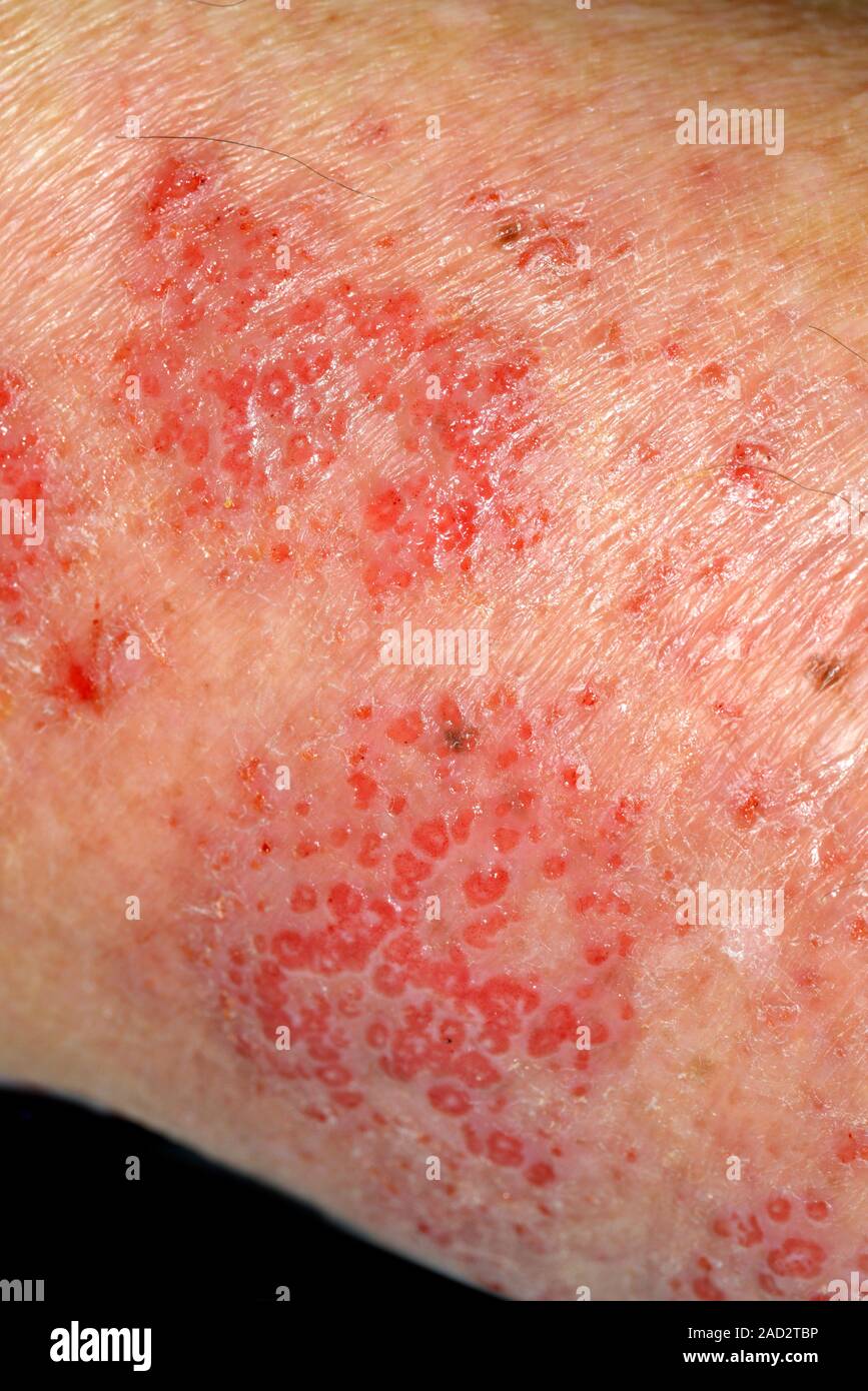 Dermatitis. Close-up of inflamed skin (dermatitis) on the arm of an 85 ...