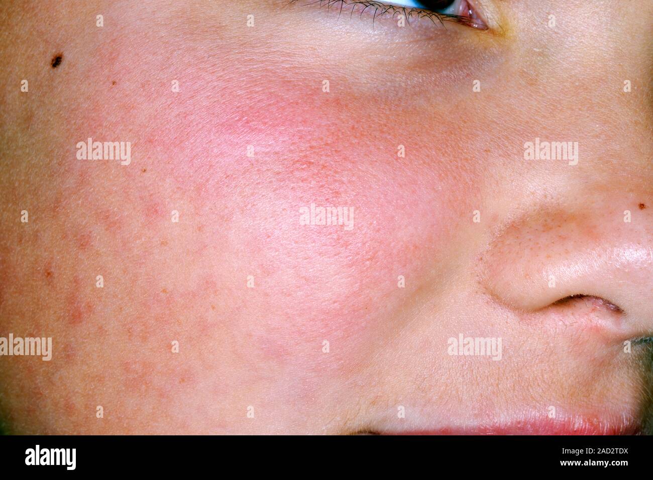 Urticaria. Close-up of urticaria on the face of an 11-year-old female ...