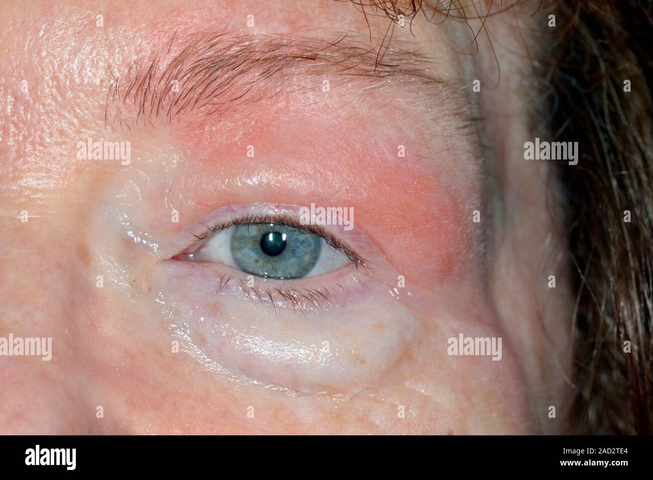 Swollen eyelid. Close-up of oedema (fluid accumulation) of unknown ...