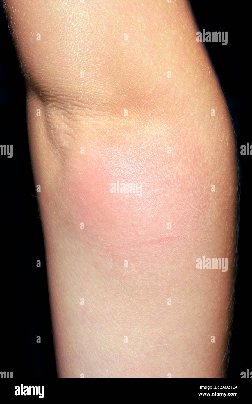 Allergic reaction to mosquito bite. Close-up of the swollen leg of an 8 ...