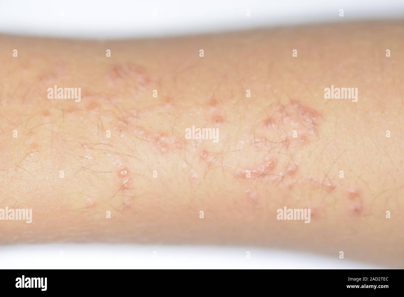 Allergic reaction to henna tattoo. Close-up of the swollen arm of a 7 ...