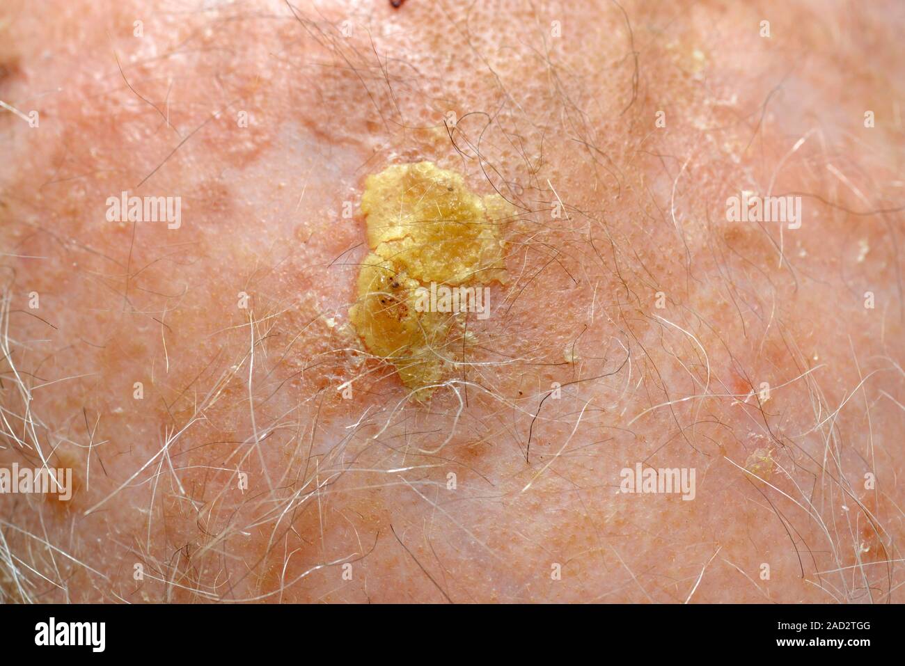 Solar keratosis of the scalp. Close-up of the scalp of a 90-year-old ...