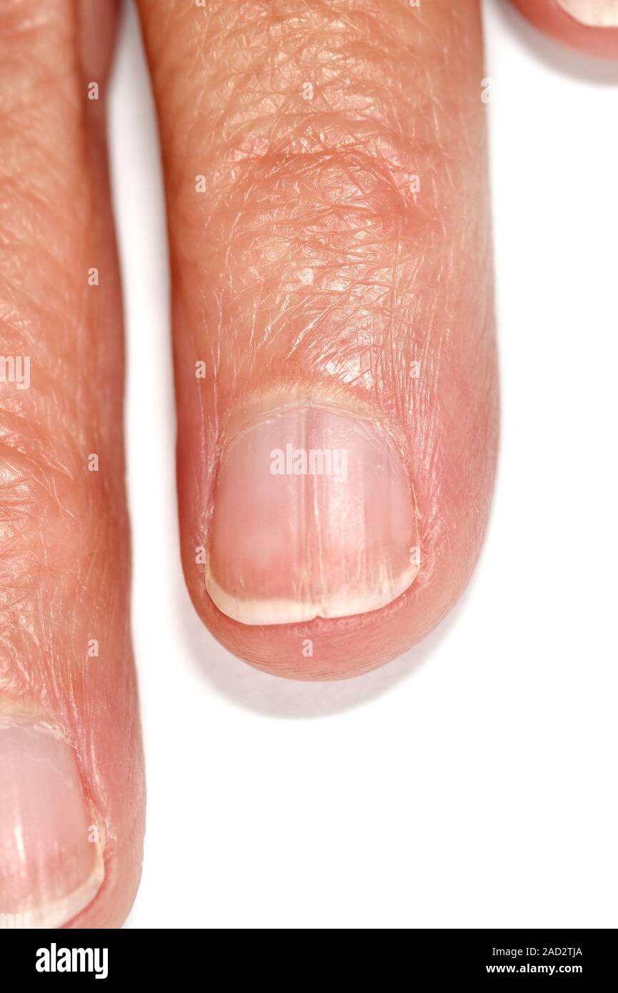 Ridged fingernail. Close-up of a ridge in the fingernail of a 55-year ...