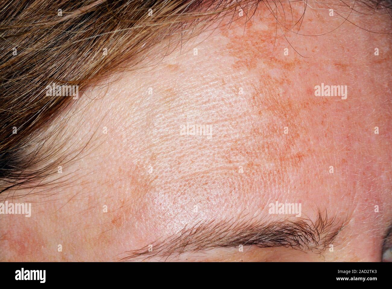 Melasma of the face. Close-up of brown patches on the face of a 38-year ...