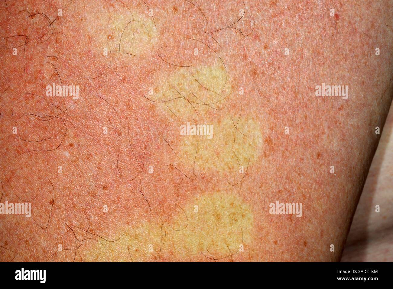 Viral rash. Close-up of the face of a 45-year-old male patient with a ...