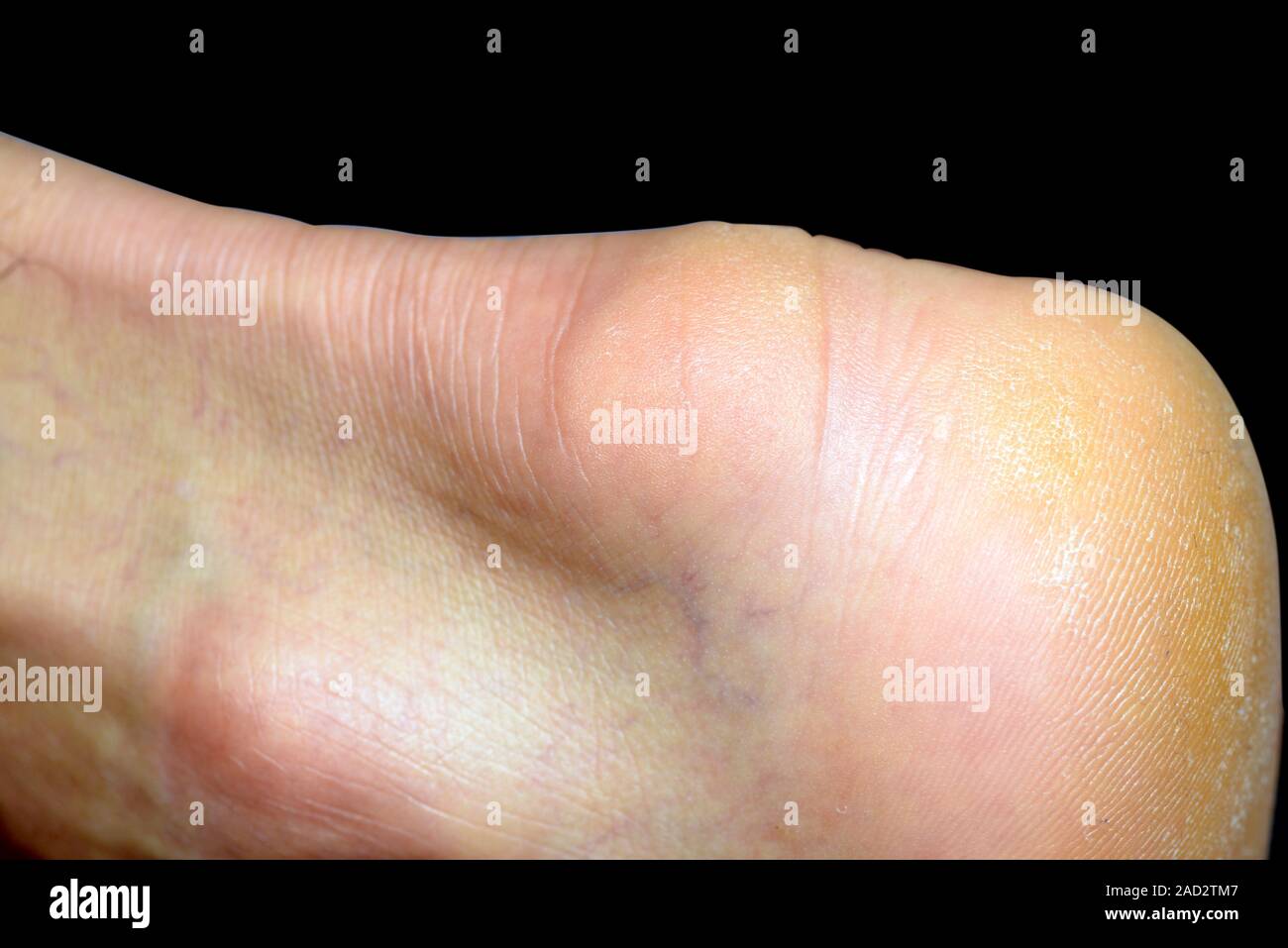 Haglund's deformity. Close-up of the heel of a 54-year-old male patient ...