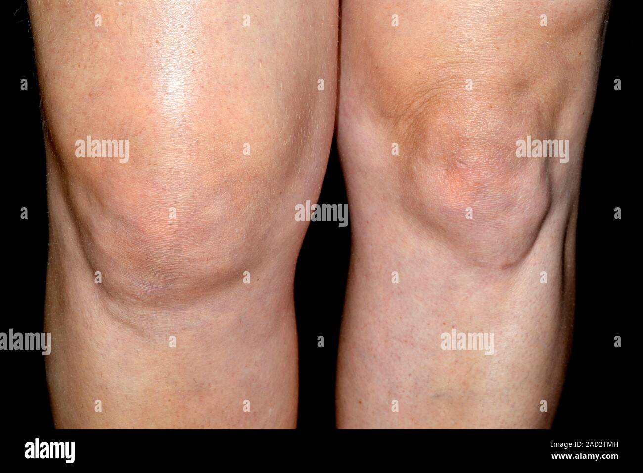 Swollen knee. Close-up of the legs of a 45-year-old female patient with ...