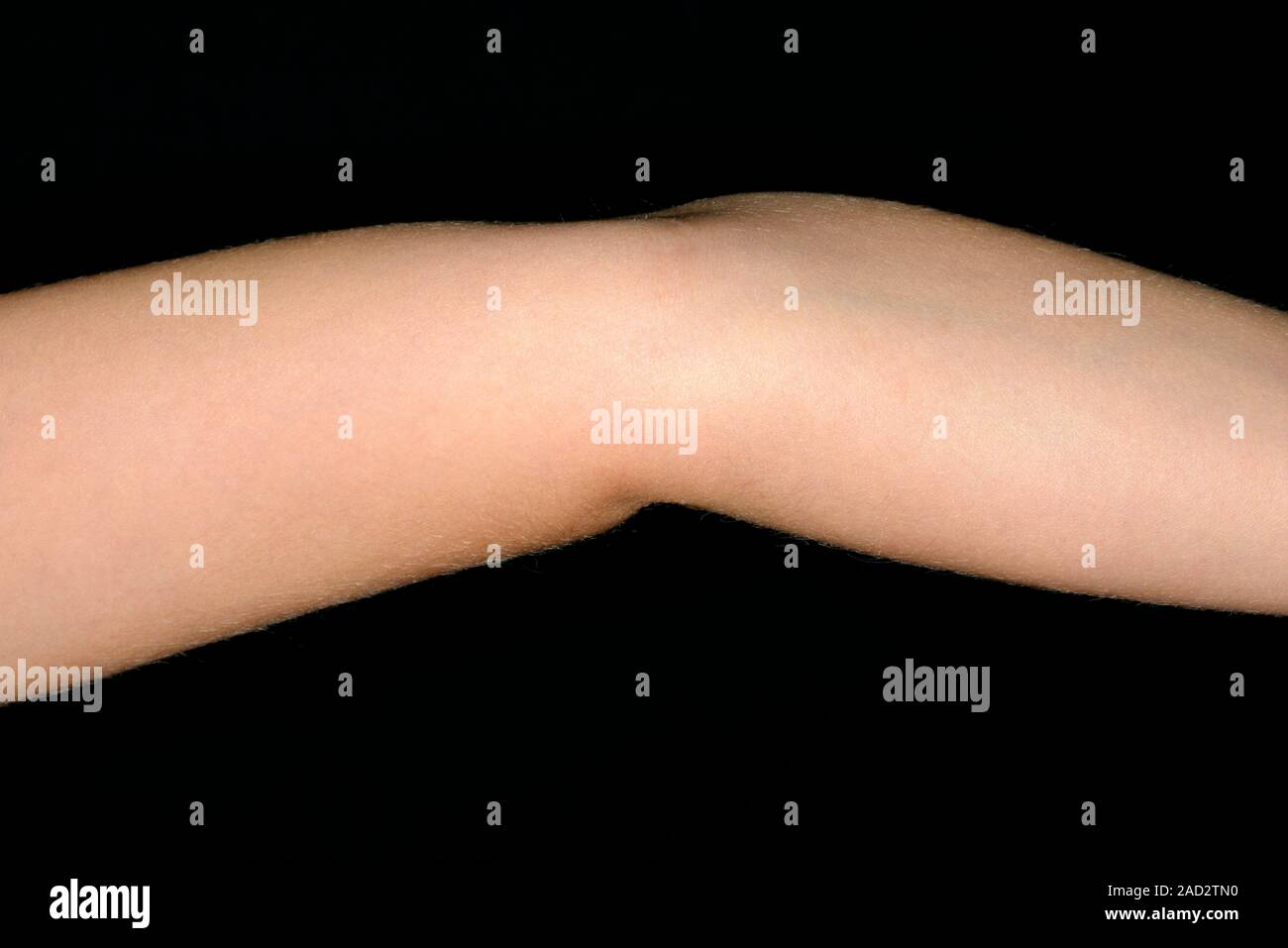 Hypermobility of the elbow. Close-up of the arm of a 7-year-old female patient with a ...