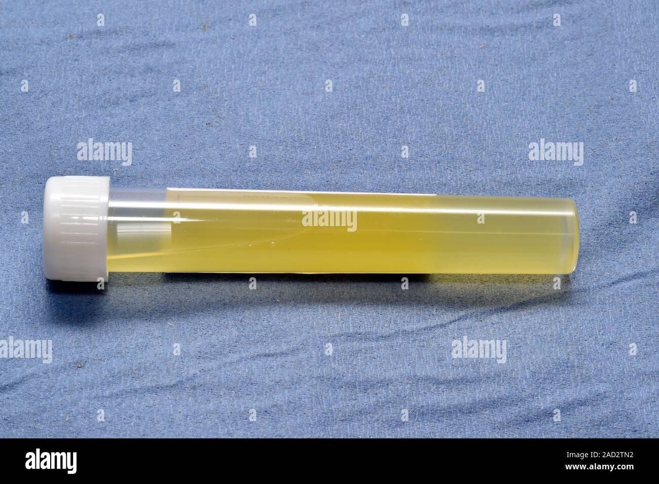Pseudogout fluid from knee. Vial of fluid aspirated (removed) from the ...