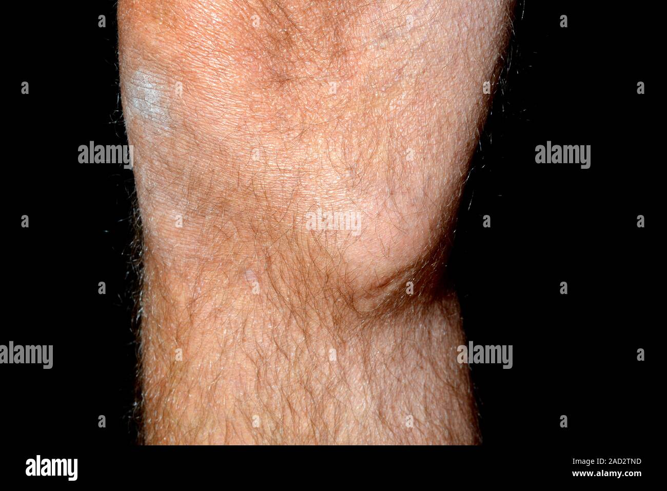 Torn knee ligament. Close-up of the swollen knee of a 65-year-old male ...