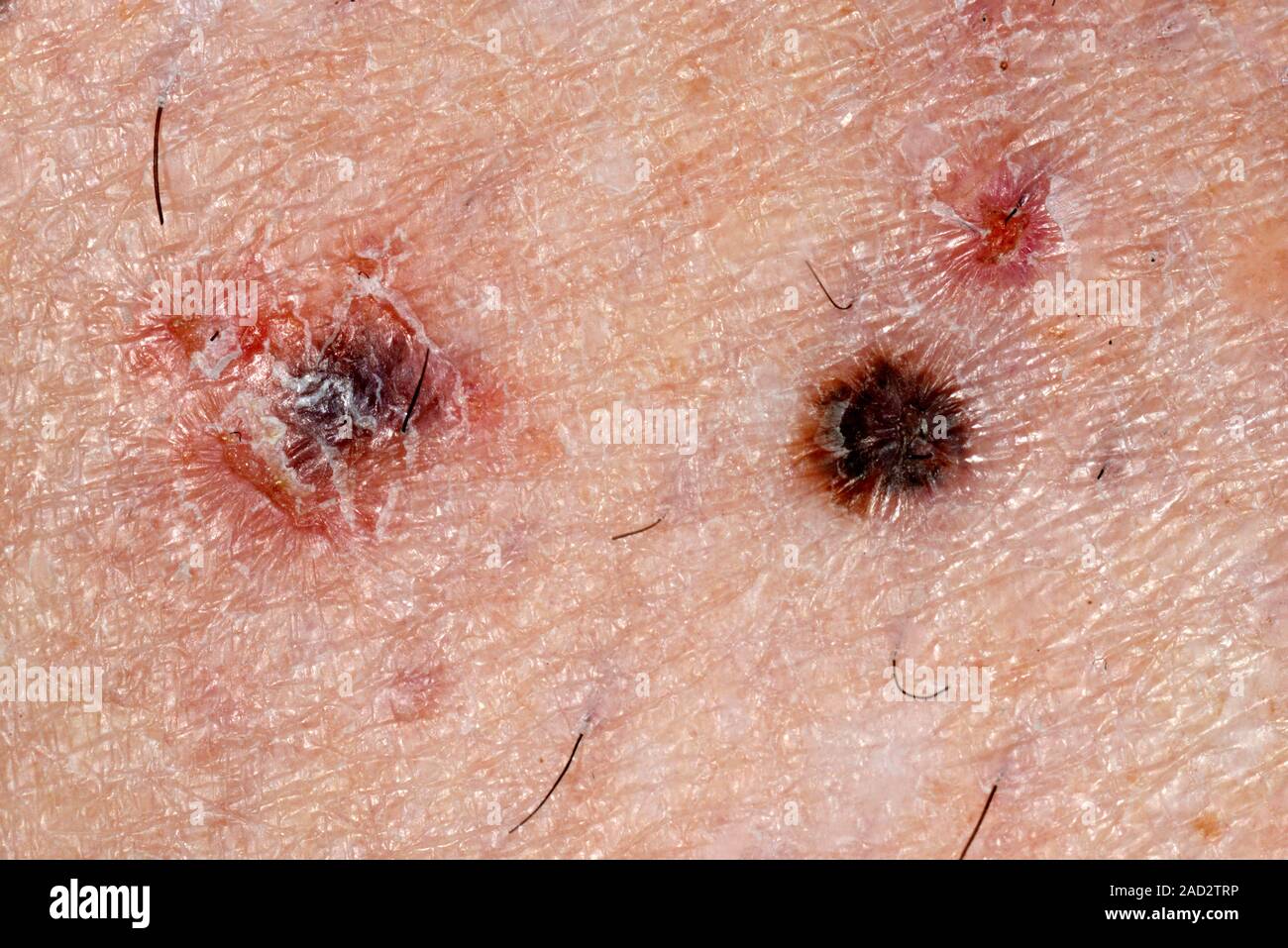 Skin cancer and non-cancerous lesion. Close-up of a malignant (cancerous) melanoma (left) and ...