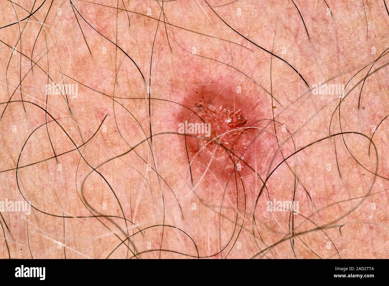 Skin cancer. Close-up of basal cell carcinoma (skin cancer) on the skin ... Skin cancer. Close-up of basal cell carcinoma (skin cancer) on the skin ...