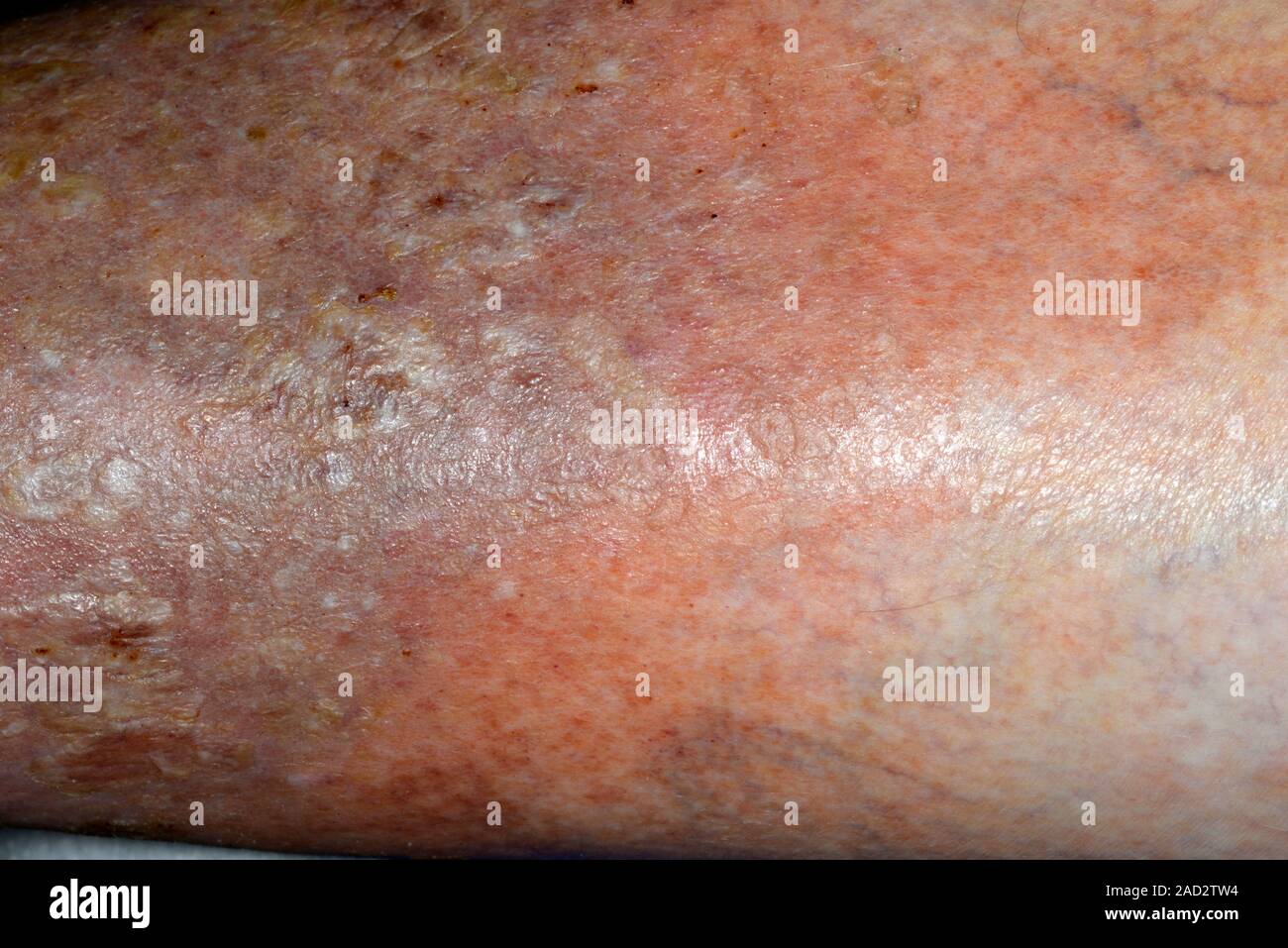 Psoriasis. Close-up of psoriasis affecting the leg of a 63-year-old ...
