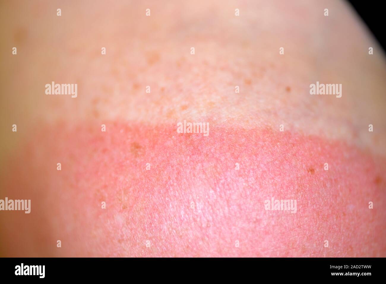 Sunburn. Close-up of sunburn on the upper arm of a 62-year-old female ...