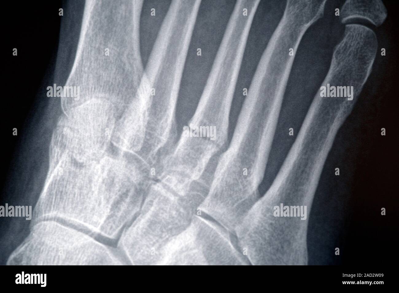 Broken toe. X-ray of the foot of a 70-year-old male patient with a ...