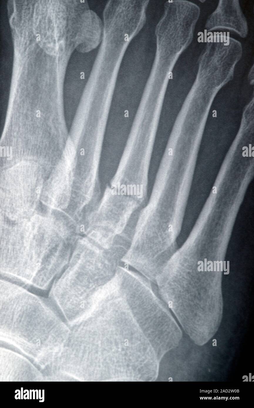 Broken toe. X-ray of the foot of a 70-year-old male patient with a ...