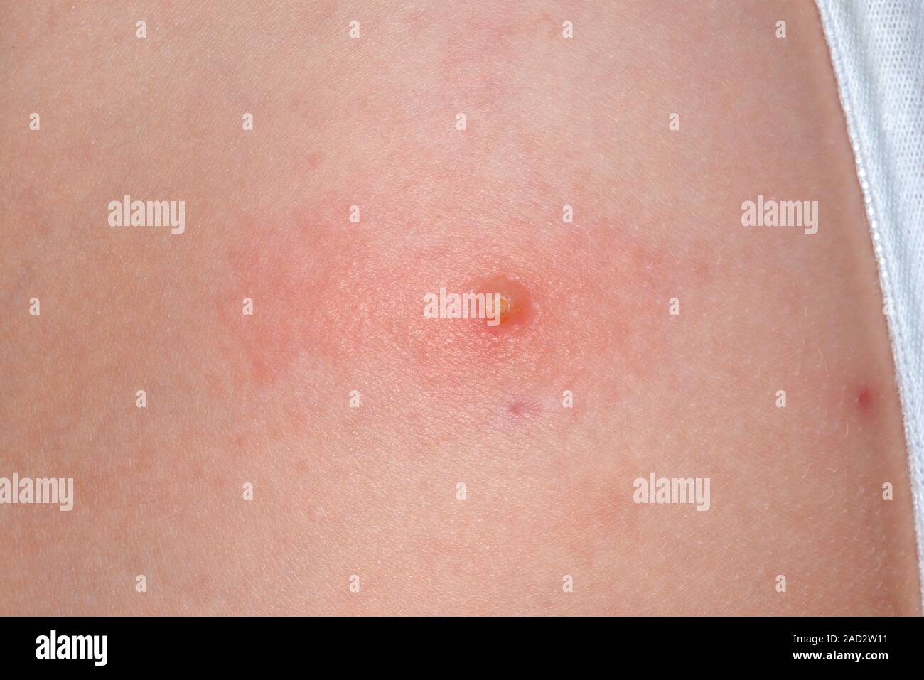 molluscum contagiosum. Close-up of an infected molluscum contagiosum ...