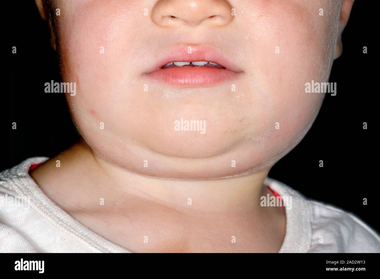 Mumps. Close-up of the swollen face of a 2-year-old female patient with ...