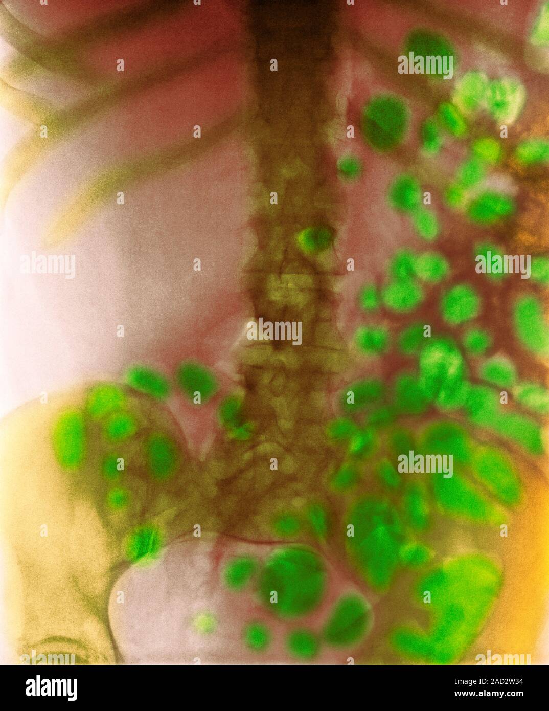 Distended bowel in alcohol and drug abuse. Coloured X-ray of a section ...