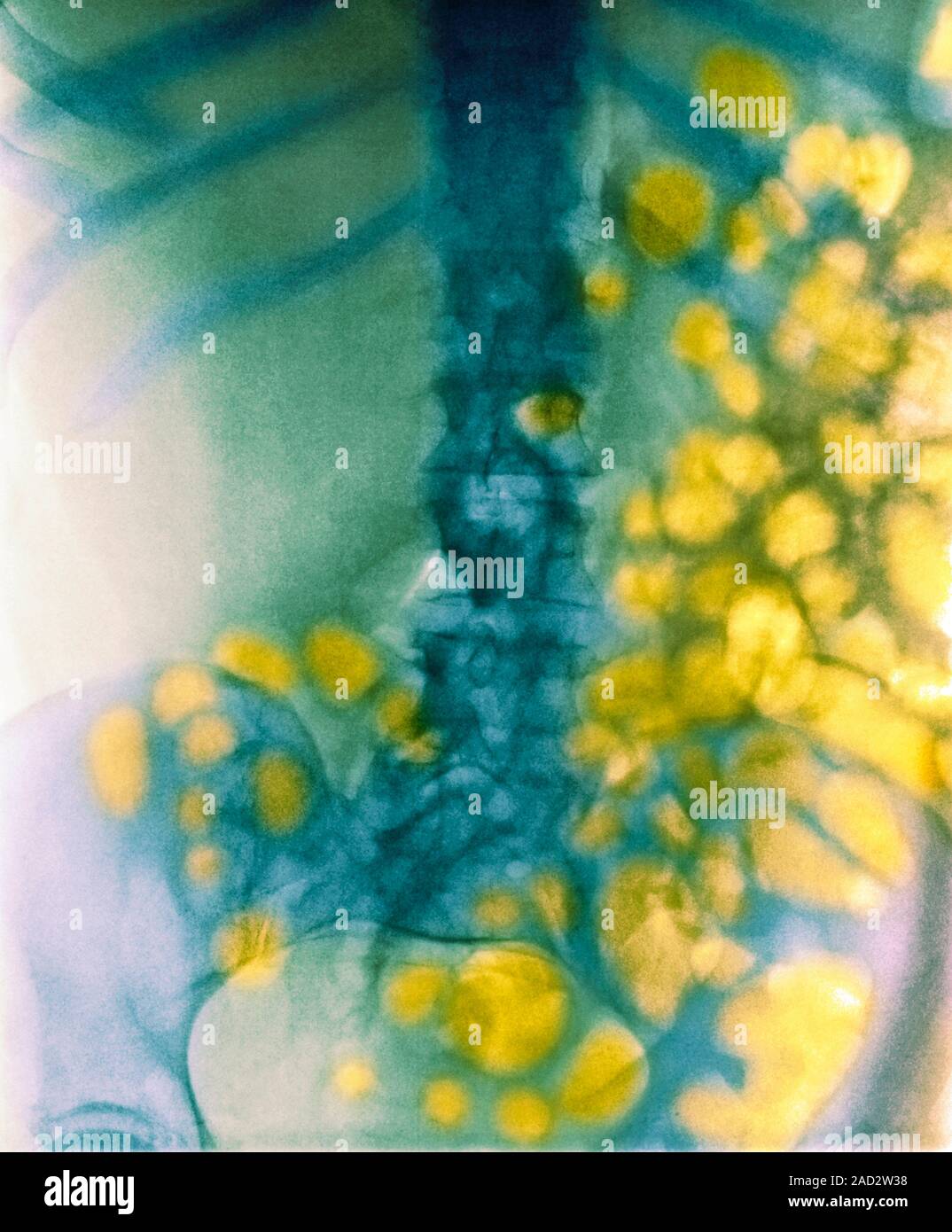 Distended bowel in alcohol and drug abuse. Coloured X-ray of a section ...