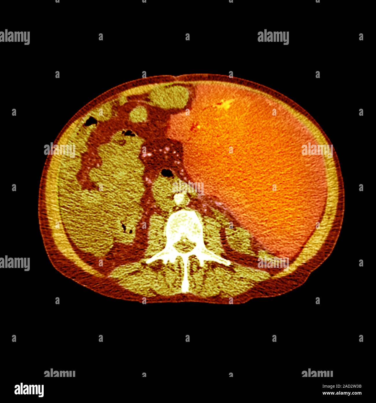 Secondary peritoneal cancer. Coloured computed tomography (CT) scan of ...