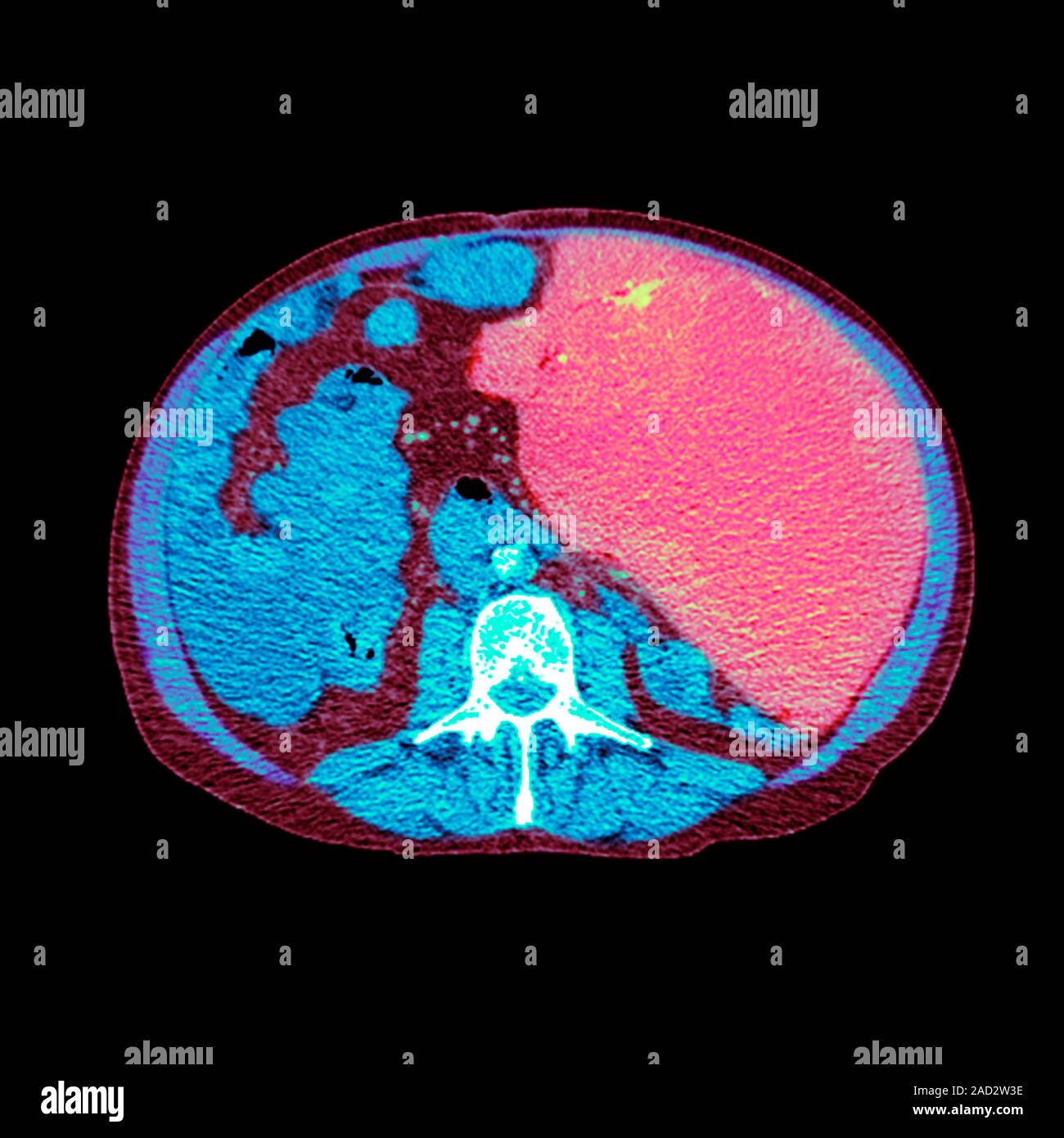 Secondary peritoneal cancer. Coloured computed tomography (CT) scan of an axial section through ...