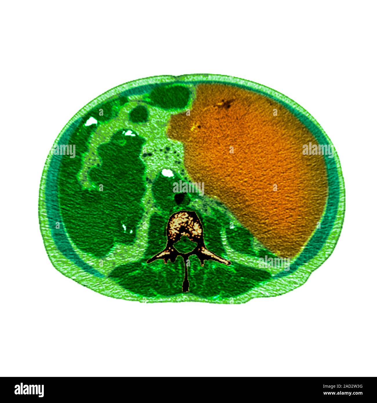 Secondary peritoneal cancer. Coloured computed tomography (CT) scan of ... Secondary peritoneal cancer. Coloured computed tomography (CT) scan of ...