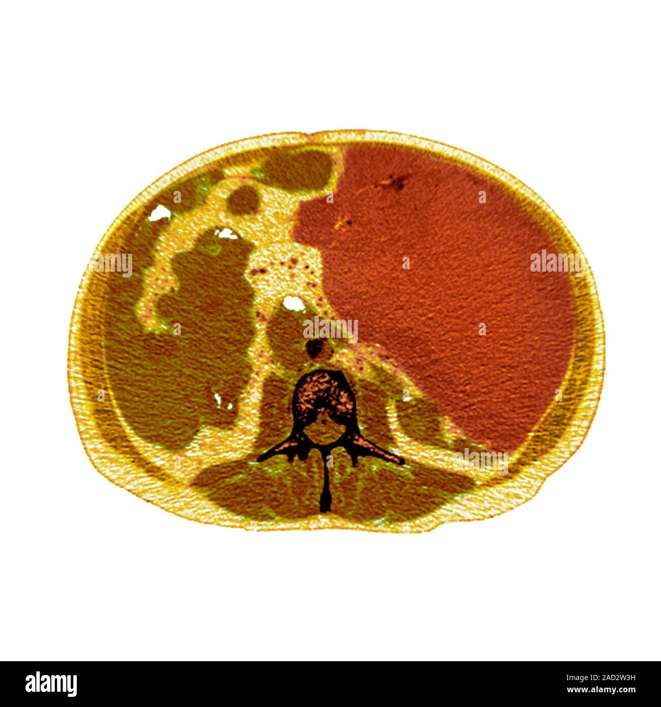 Secondary peritoneal cancer. Coloured computed tomography (CT) scan of ...