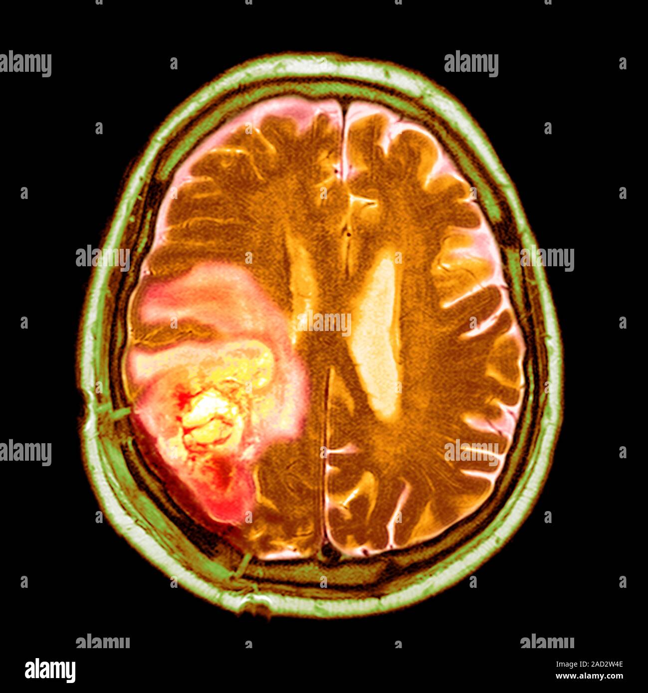 Brain cancer. Coloured magnetic resonance imaging (MRI) scan of a section through the head of a ...