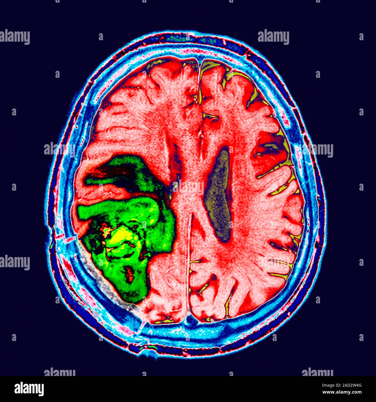 Brain cancer. Coloured magnetic resonance imaging (MRI) scan of a section through the head of a ...