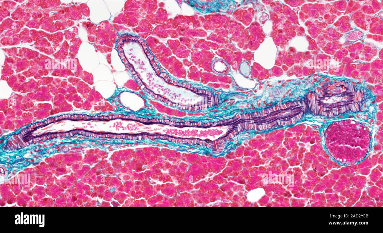 Light microscopy of a small muscular artery showing evidence of ...