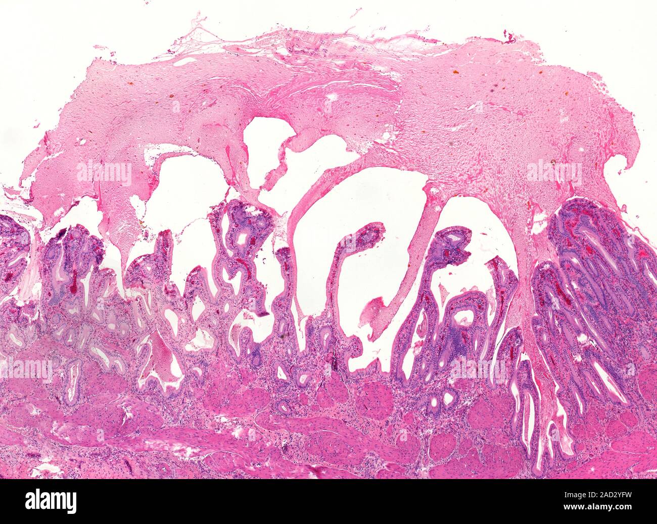 Human gall bladder exhibiting inflammation, known as cholecystitis ...