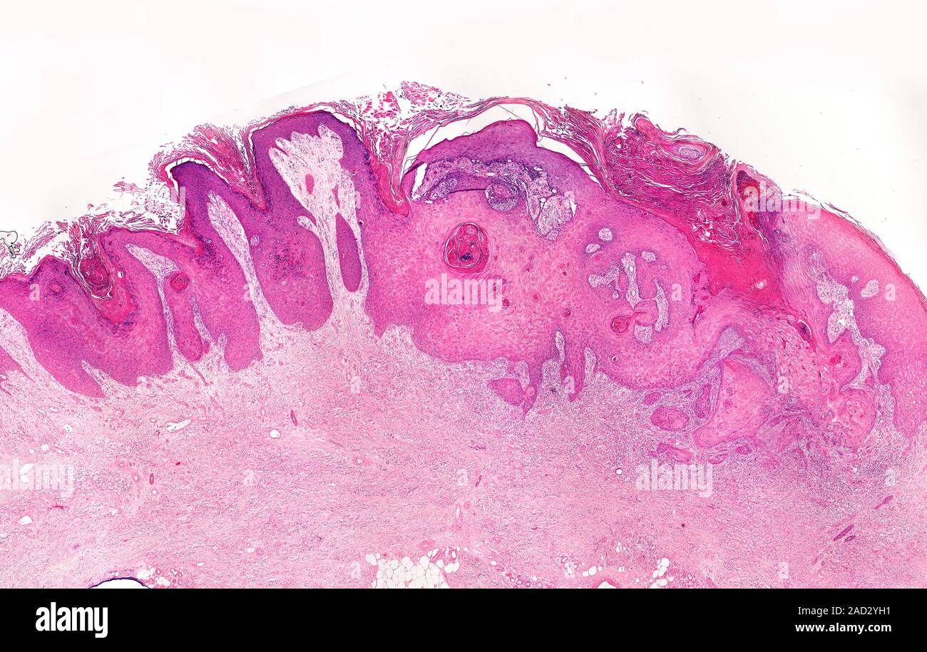 Light microscopy of squamous cell carcinoma of skin. A type of skin ...