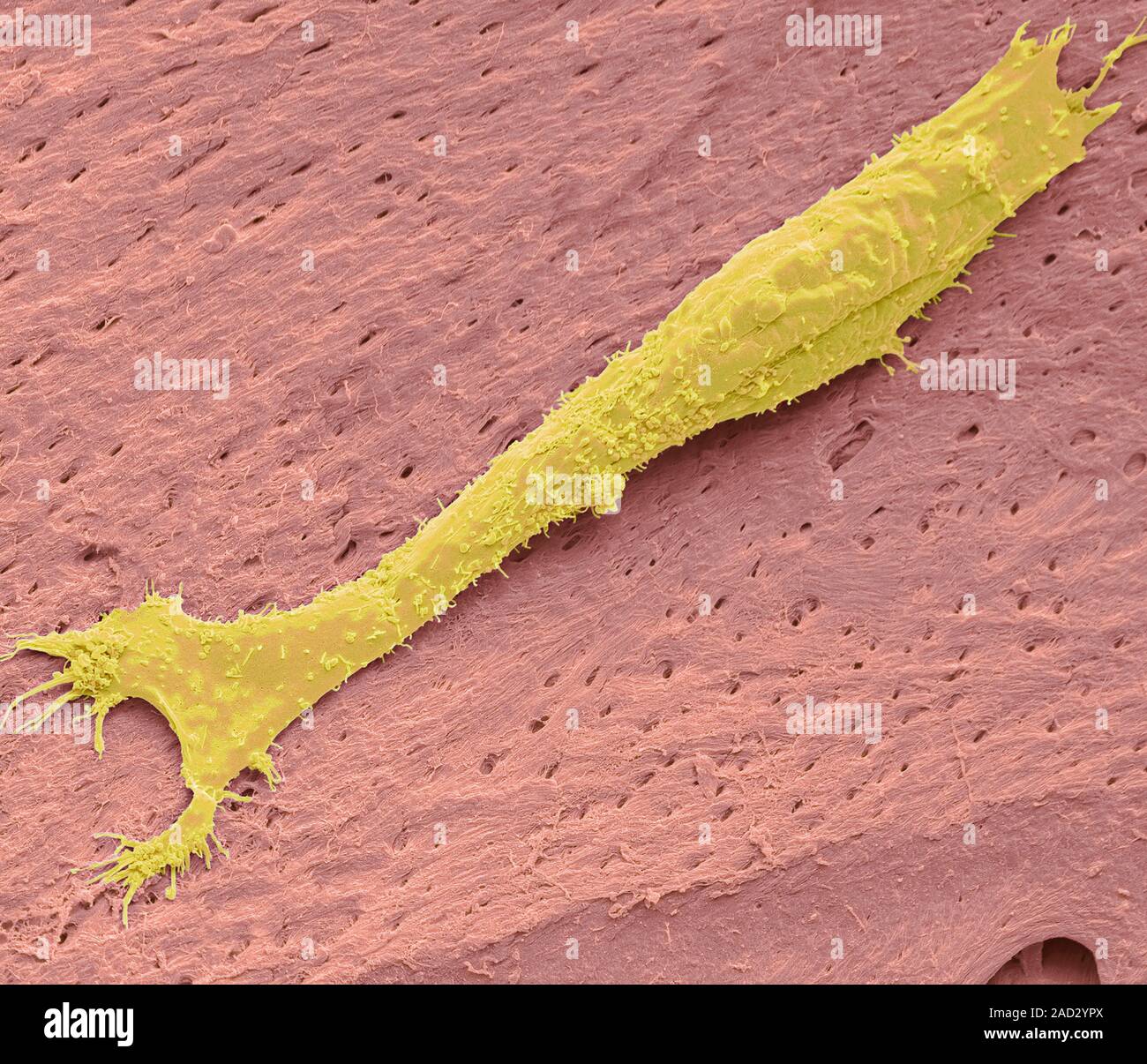 Bone cancer cell. Coloured scanning electron micrograph of an ...
