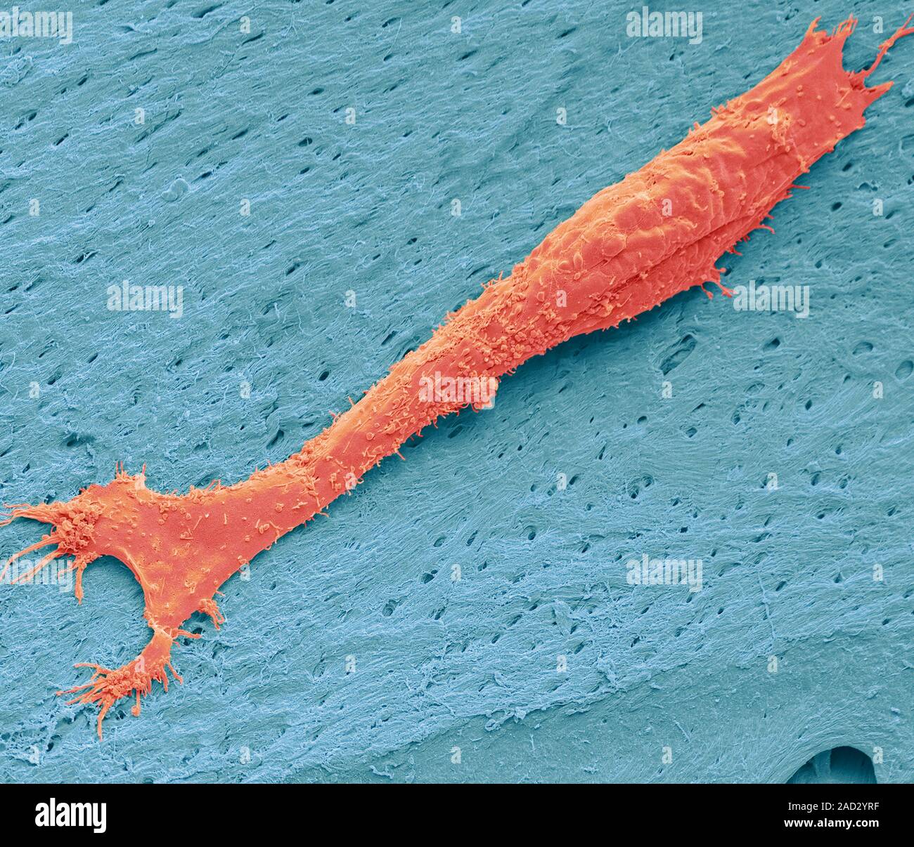Bone cancer cell. Coloured scanning electron micrograph of an ...